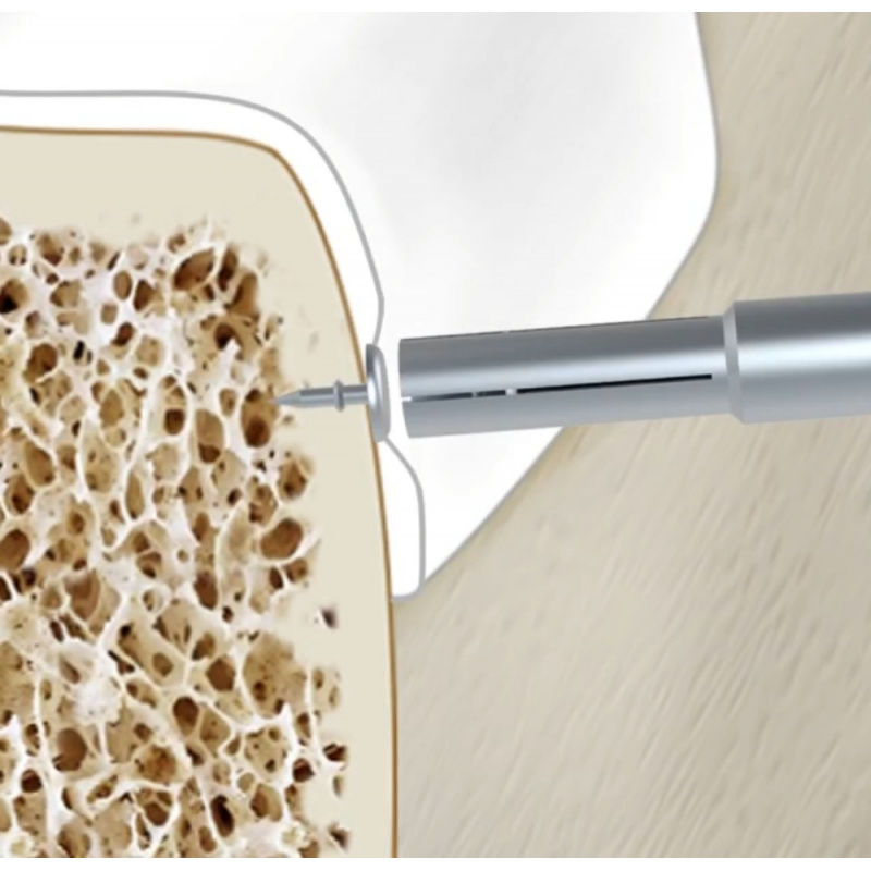 Pinject Smart Kit osteosynthesis titanium pins